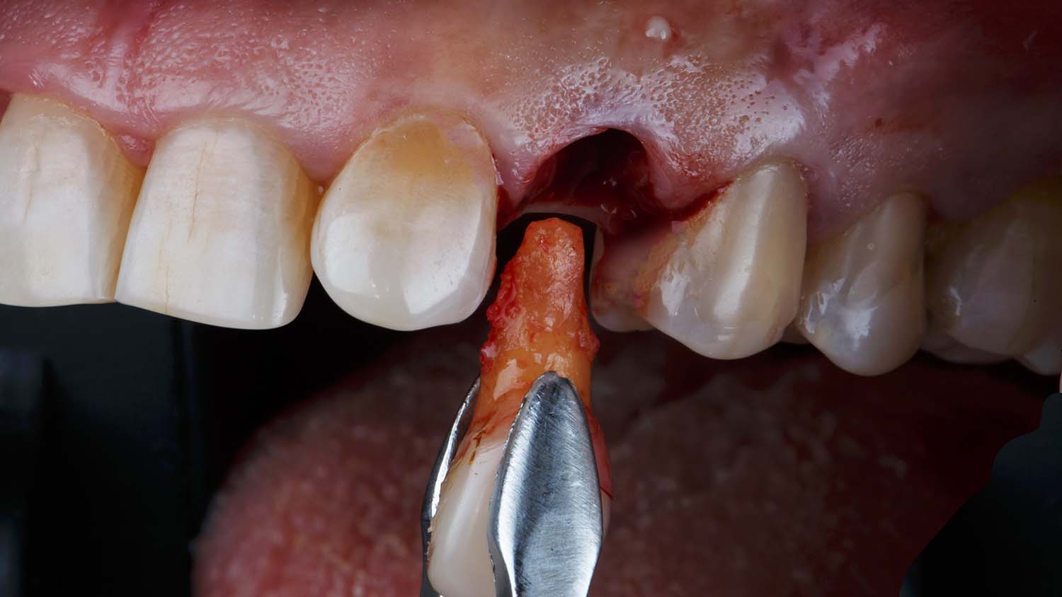 What You Need to Do Right After Tooth Extractions